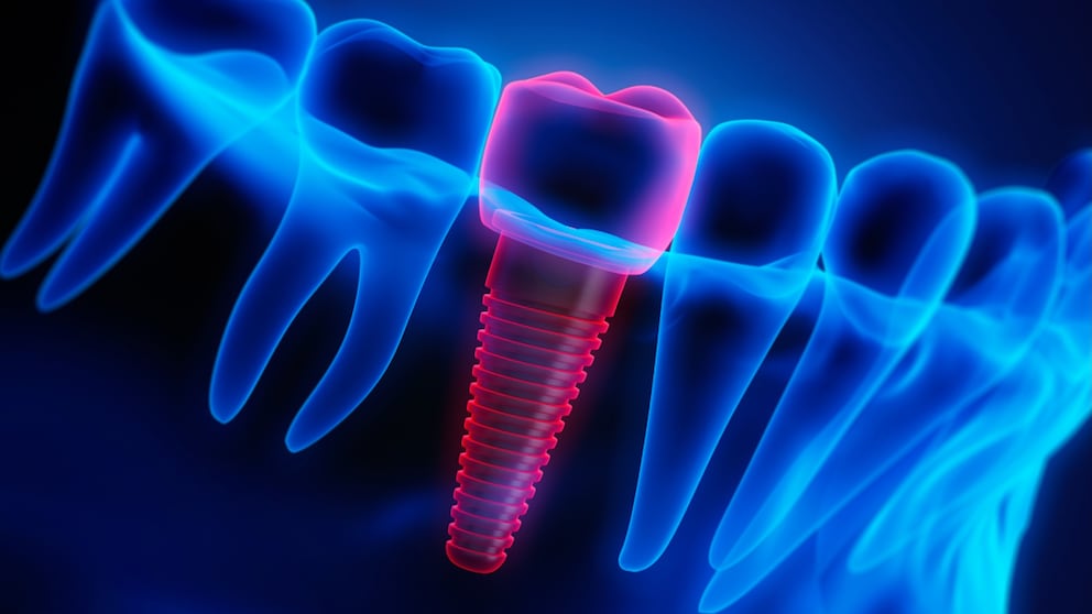 Excessive Use of Dental Implants Is the Wrong Path!
